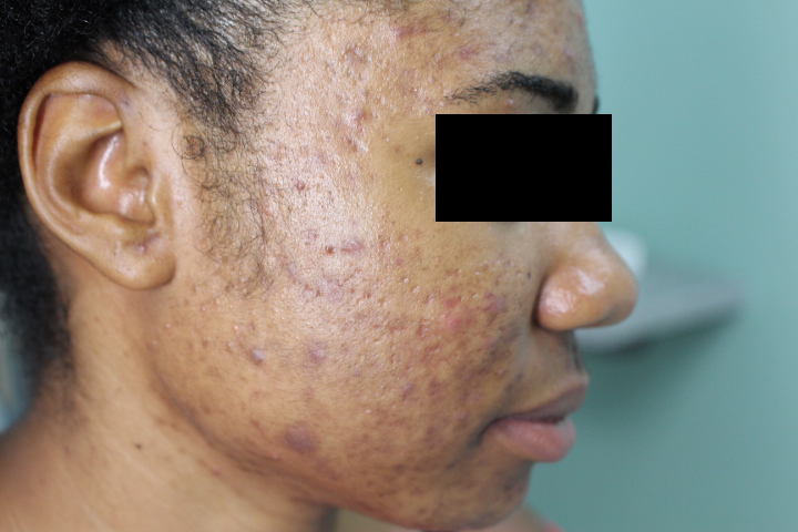 Before&After | Skin Envy Dermatology